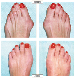 Cosmetic Foot Surgery - Englewood, NJ Foot Doctor